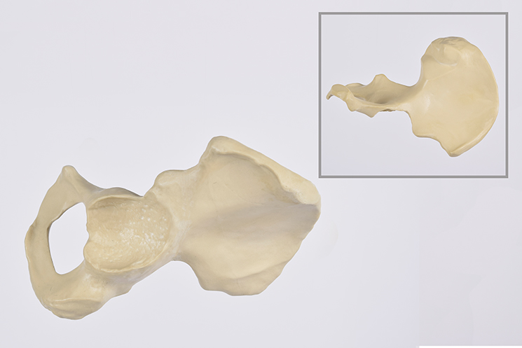 Hemi Pelvis Revision Left Synbone