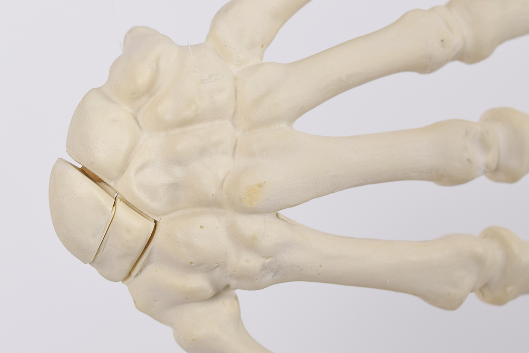 Left Scaphoid Fracture